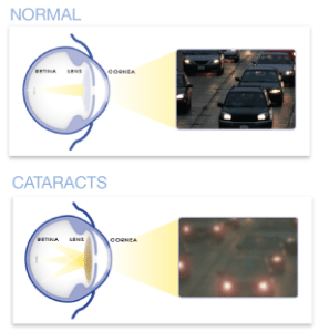 Cataract Diagnosis and Treatment MA | Northampton Eye