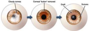 Northampton Corneal Grafts and Corneal Transplants