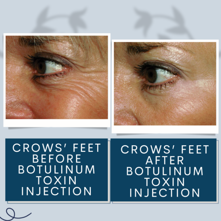 Botulinum Toxin Injections | Eye Physicians of Northampton